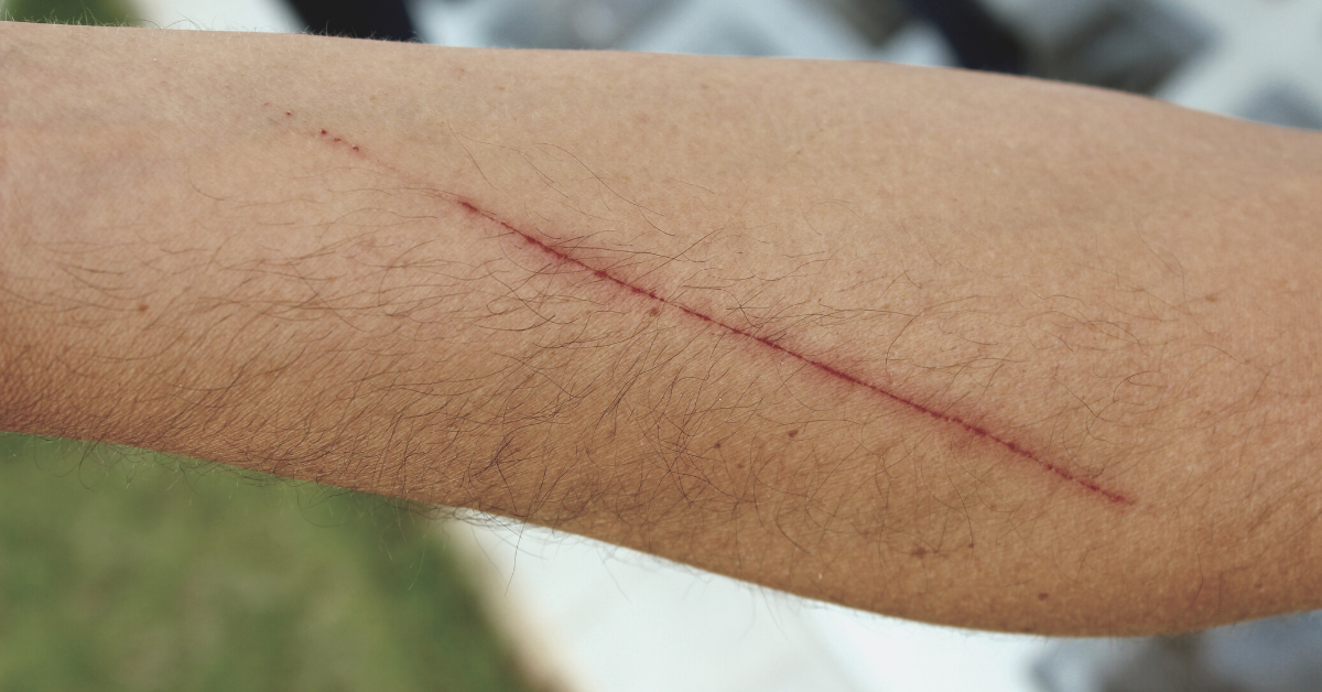 7 Important Things about Teen Cutting - Newsymom